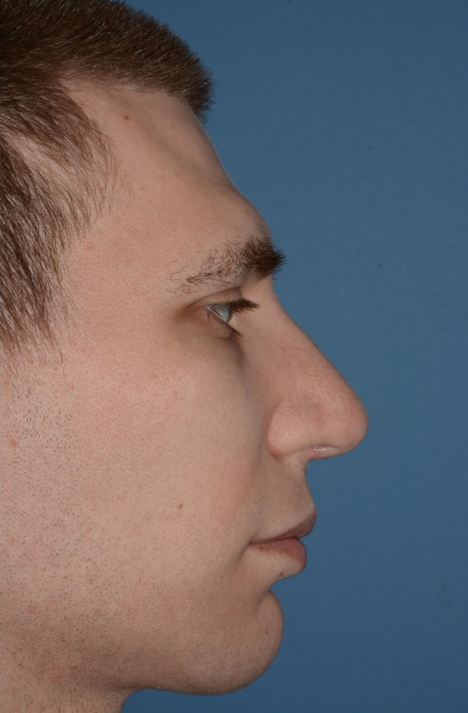 Male Rhinoplasty 16 - Robert A. Guida, MD, PC