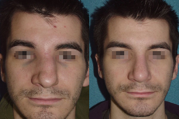 Male Rhinoplasty Index - Robert A. Guida, MD, PC